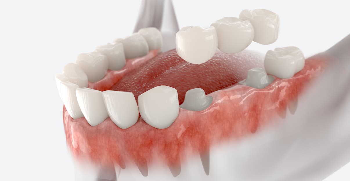 Dental Crowns: Understanding Their Lifespan and Durability - Health N Line